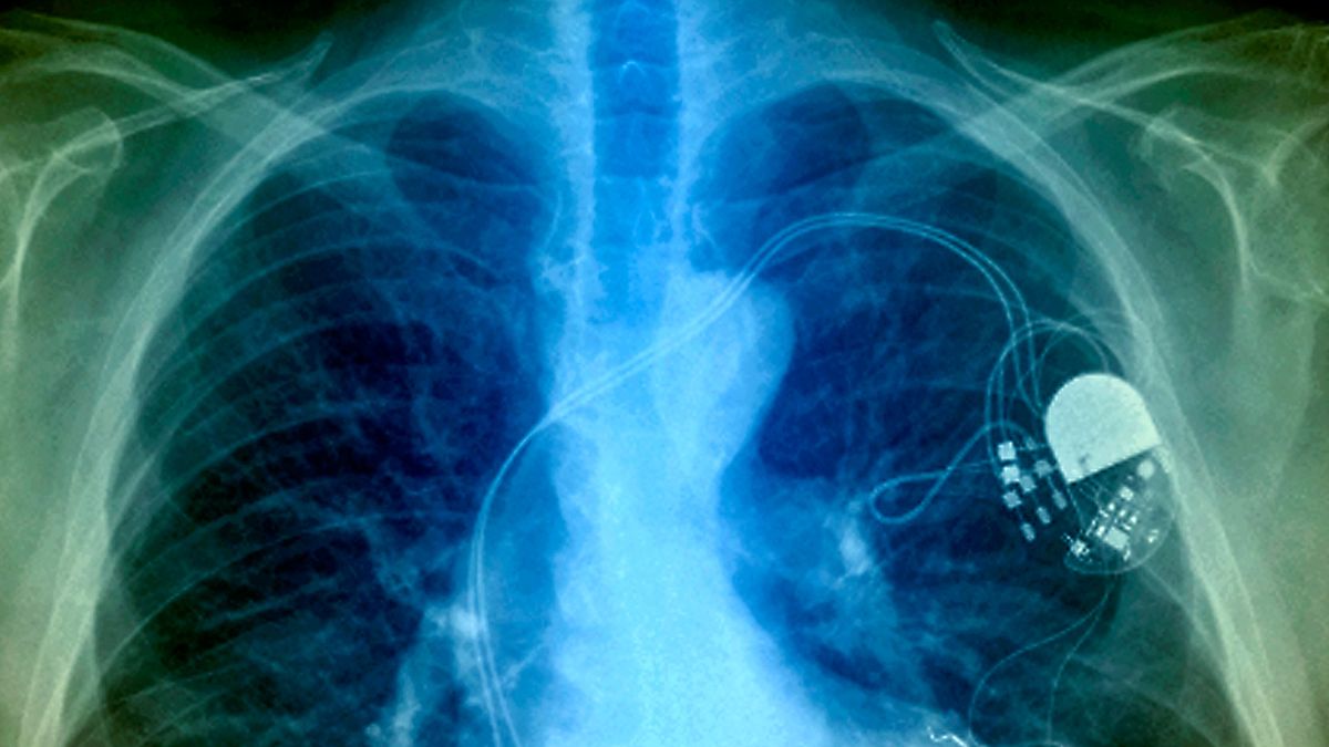 Közel félmillió pacemaker szoftverét kell frissíteni - ORIGO