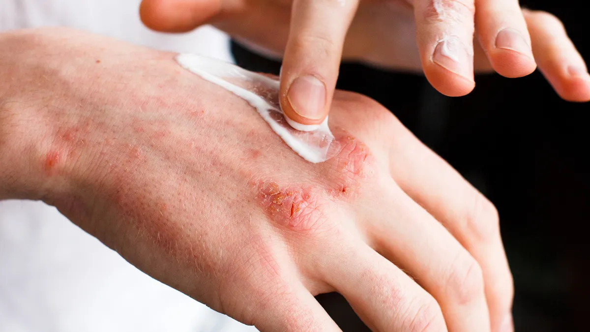 Ismert gyógykenőcsöt von ki a forgalomból az OGYÉI - ORIGO