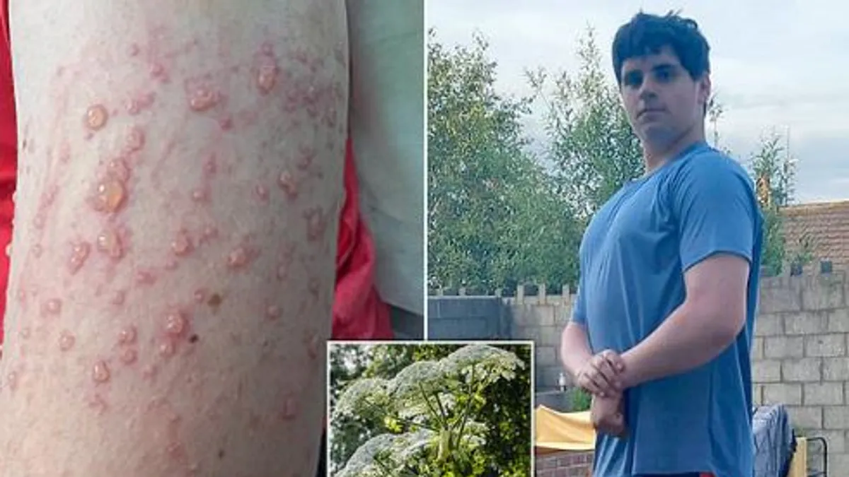 Kórházba került egy tinédzser egy veszélyes gyomnövény miatt ...